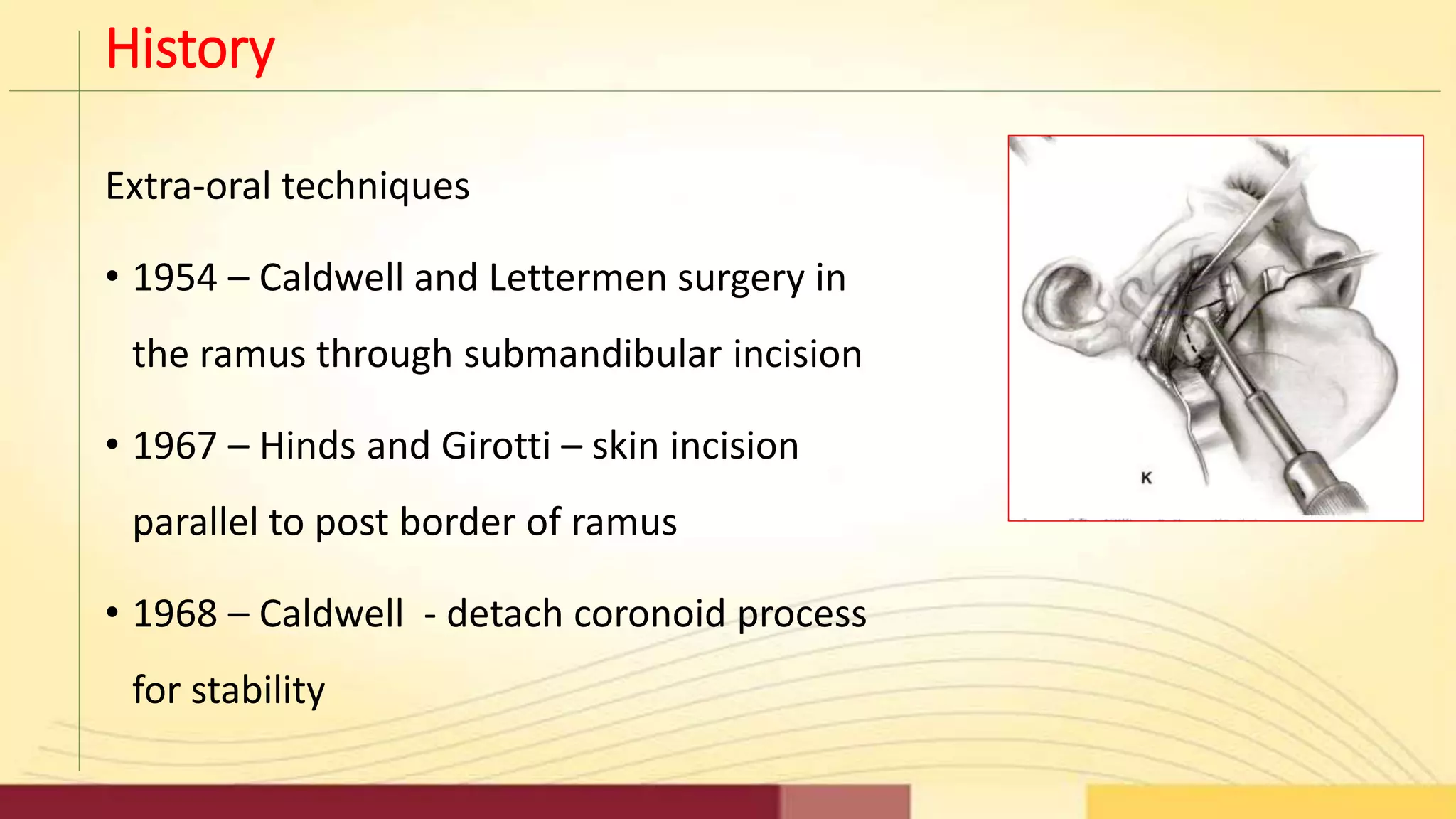 Mandibular osteotomies | PPTX