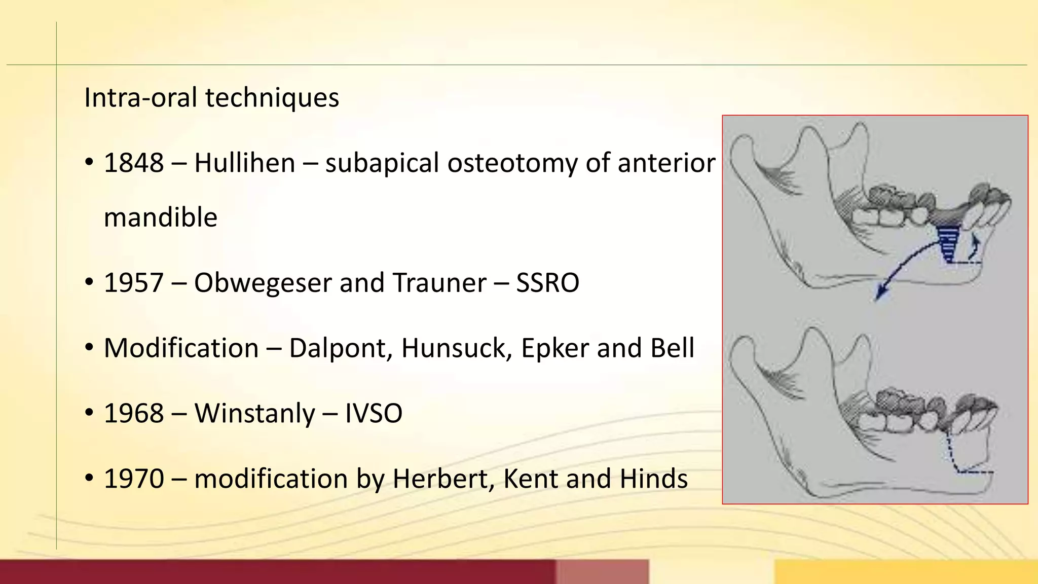Mandibular osteotomies | PPTX
