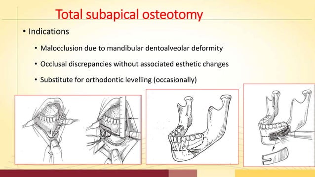Mandibular osteotomies