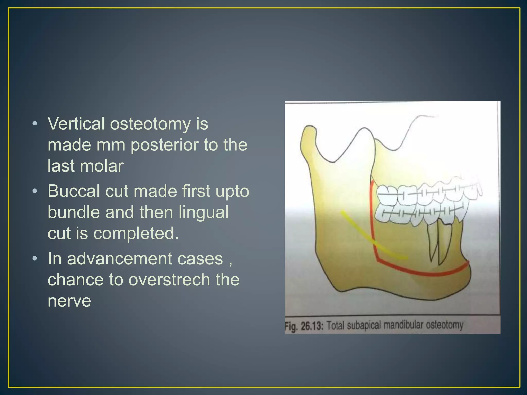 MANDIBULAR OSTEOTOMIES.pptx