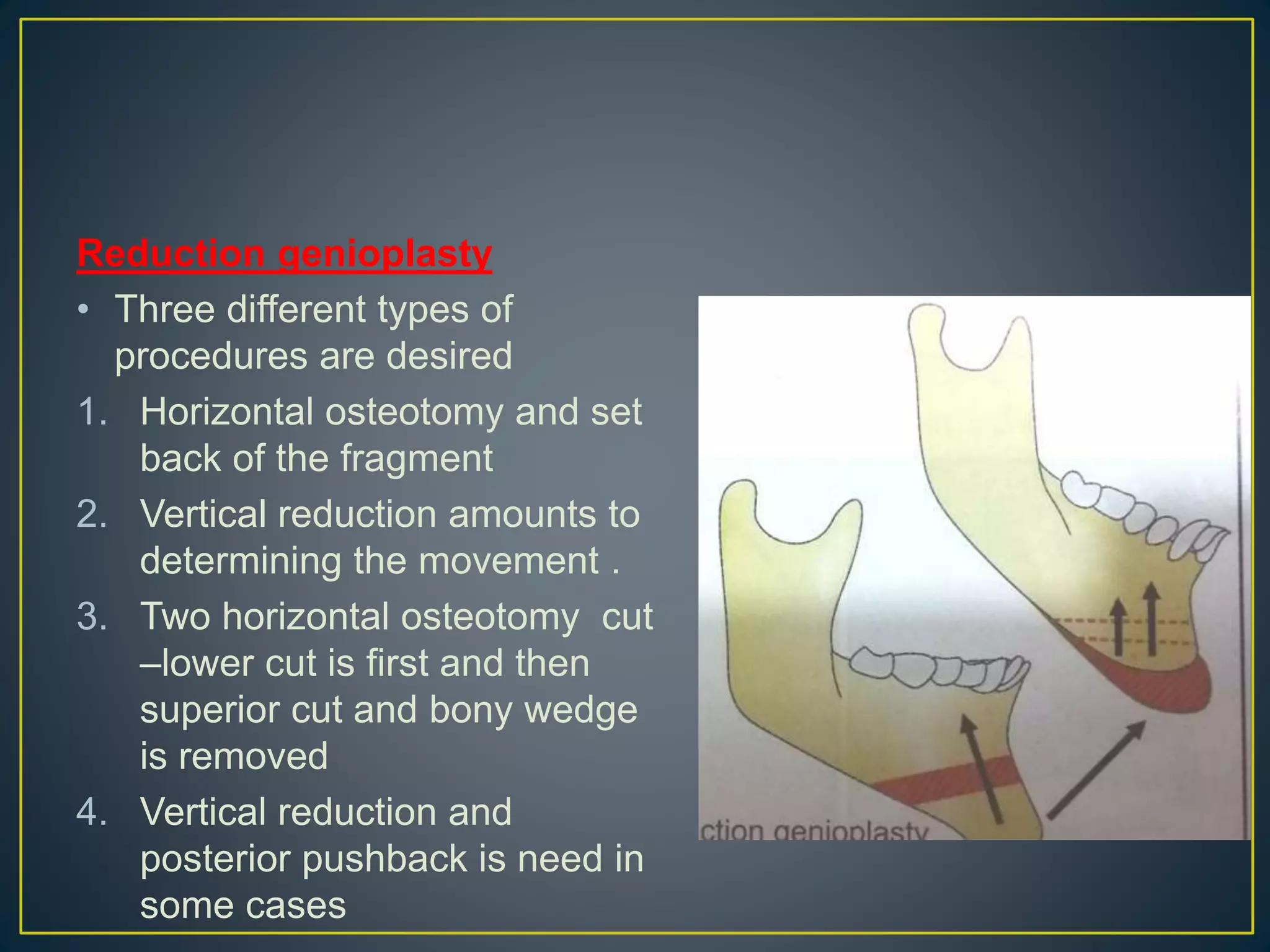 MANDIBULAR OSTEOTOMIES.pptx