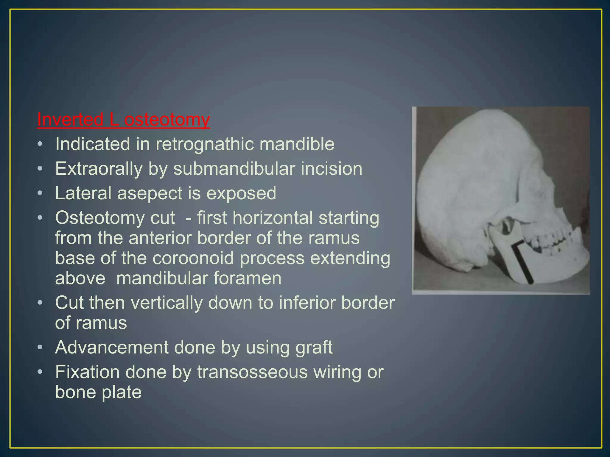 MANDIBULAR OSTEOTOMIES.pptx