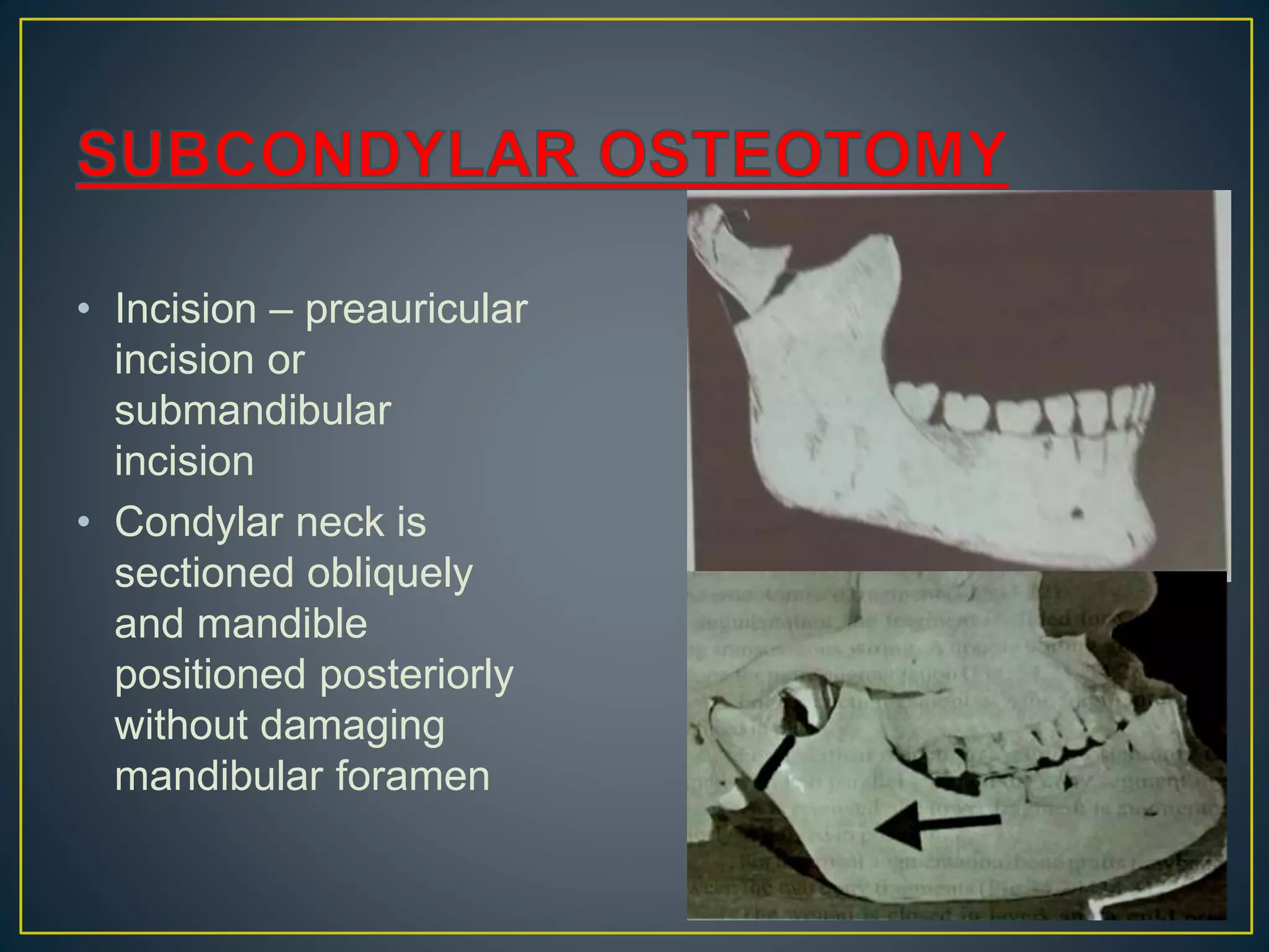 MANDIBULAR OSTEOTOMIES.pptx