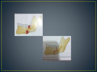 MANDIBULAR OSTEOTOMIES.pptx