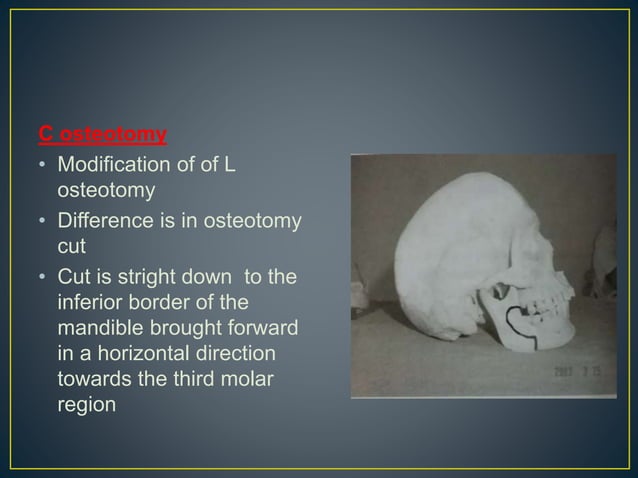 MANDIBULAR OSTEOTOMIES.pptx