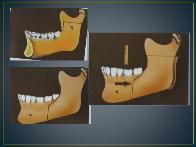 MANDIBULAR OSTEOTOMIES.pptx