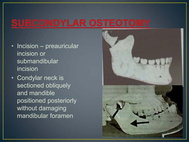 MANDIBULAR OSTEOTOMIES.pptx