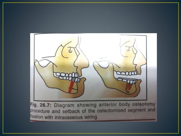 MANDIBULAR OSTEOTOMIES.pptx