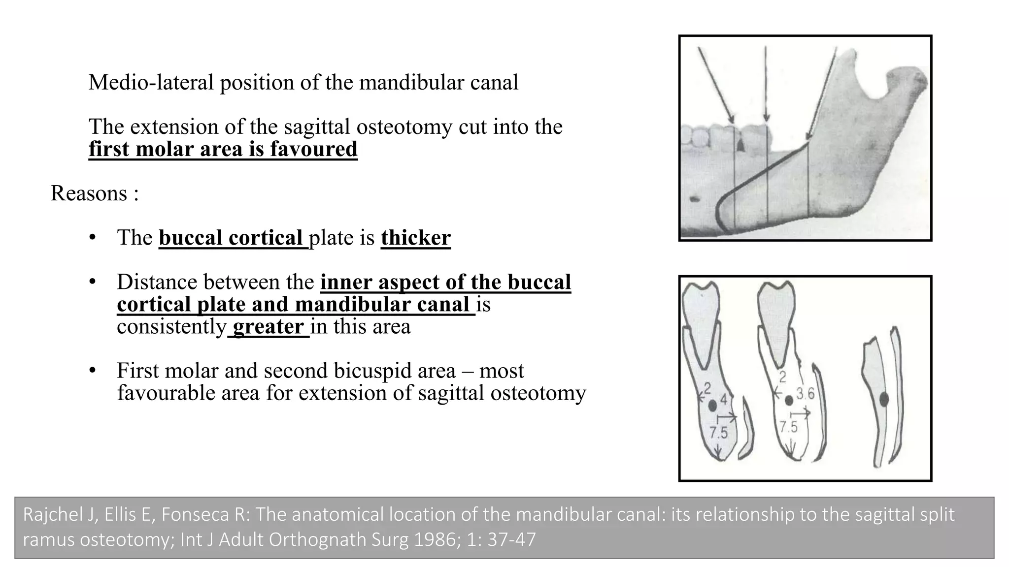Mandibular osteotomies.pptx