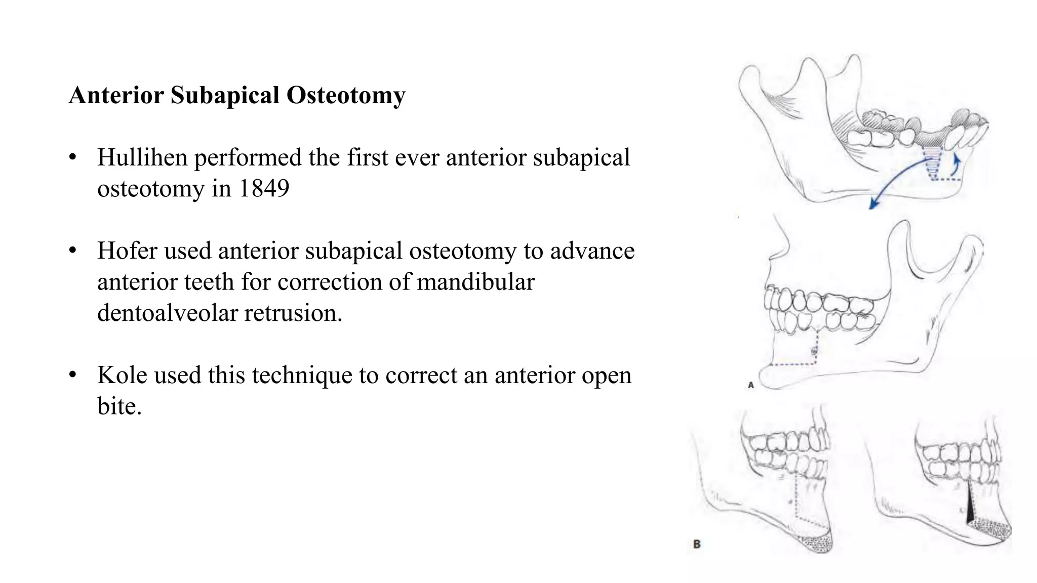 Mandibular osteotomies.pptx