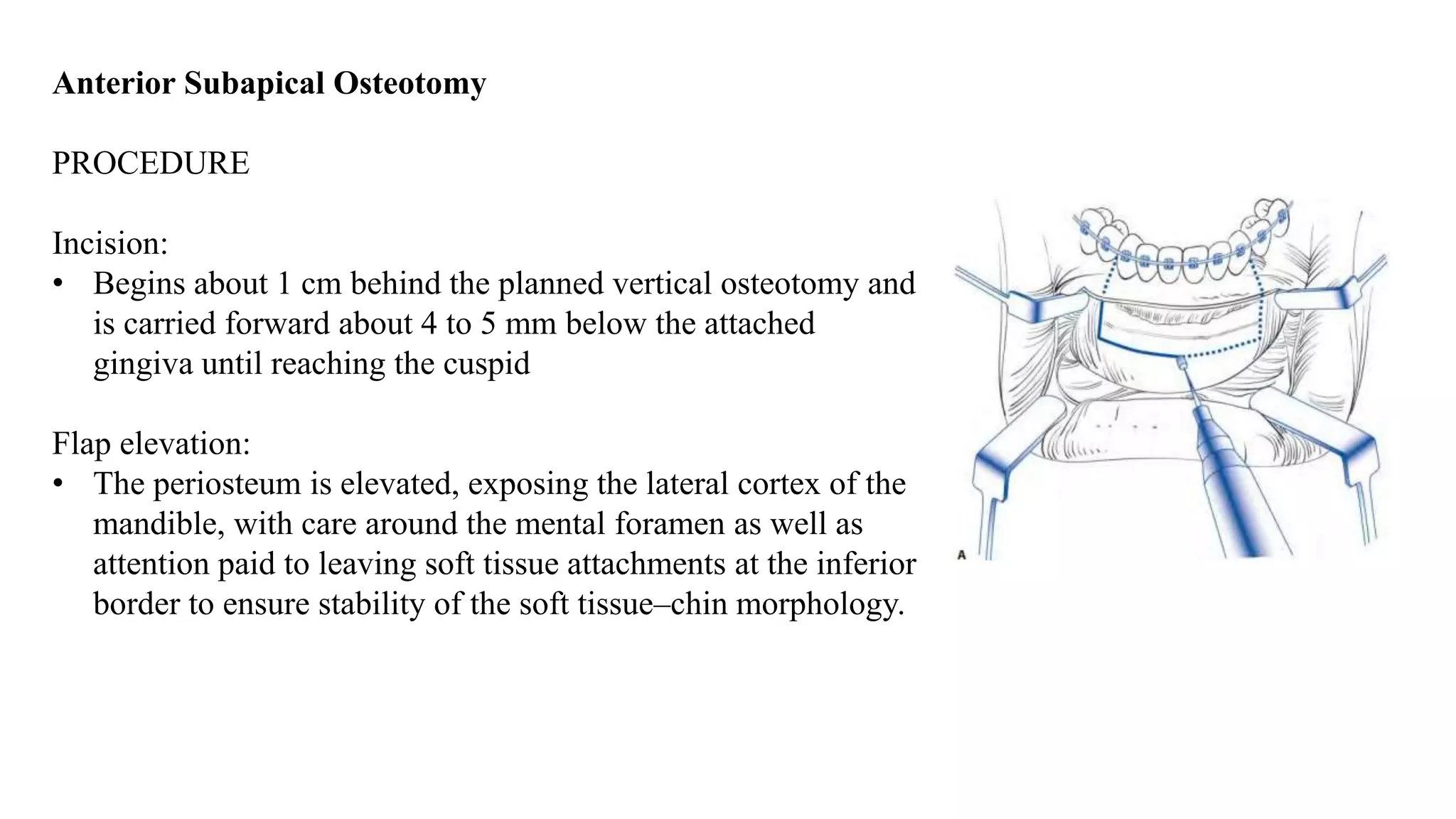Mandibular osteotomies.pptx