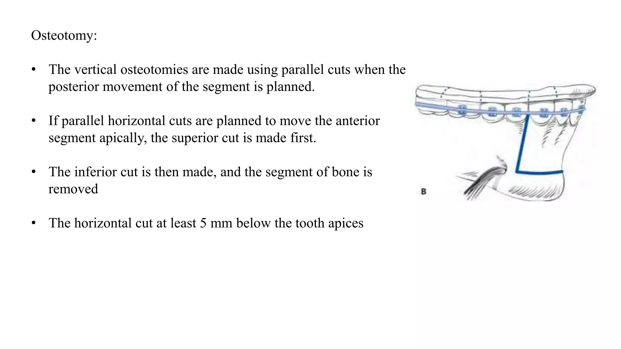 Mandibular osteotomies.pptx