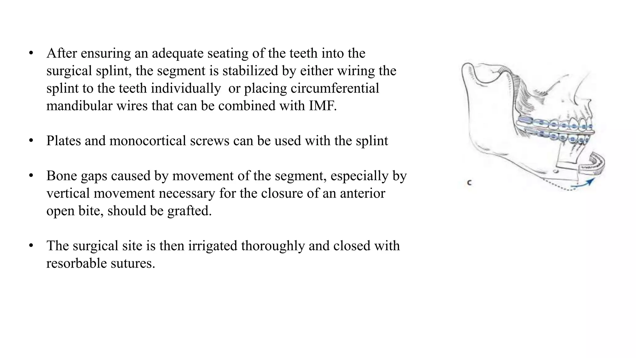 Mandibular osteotomies.pptx