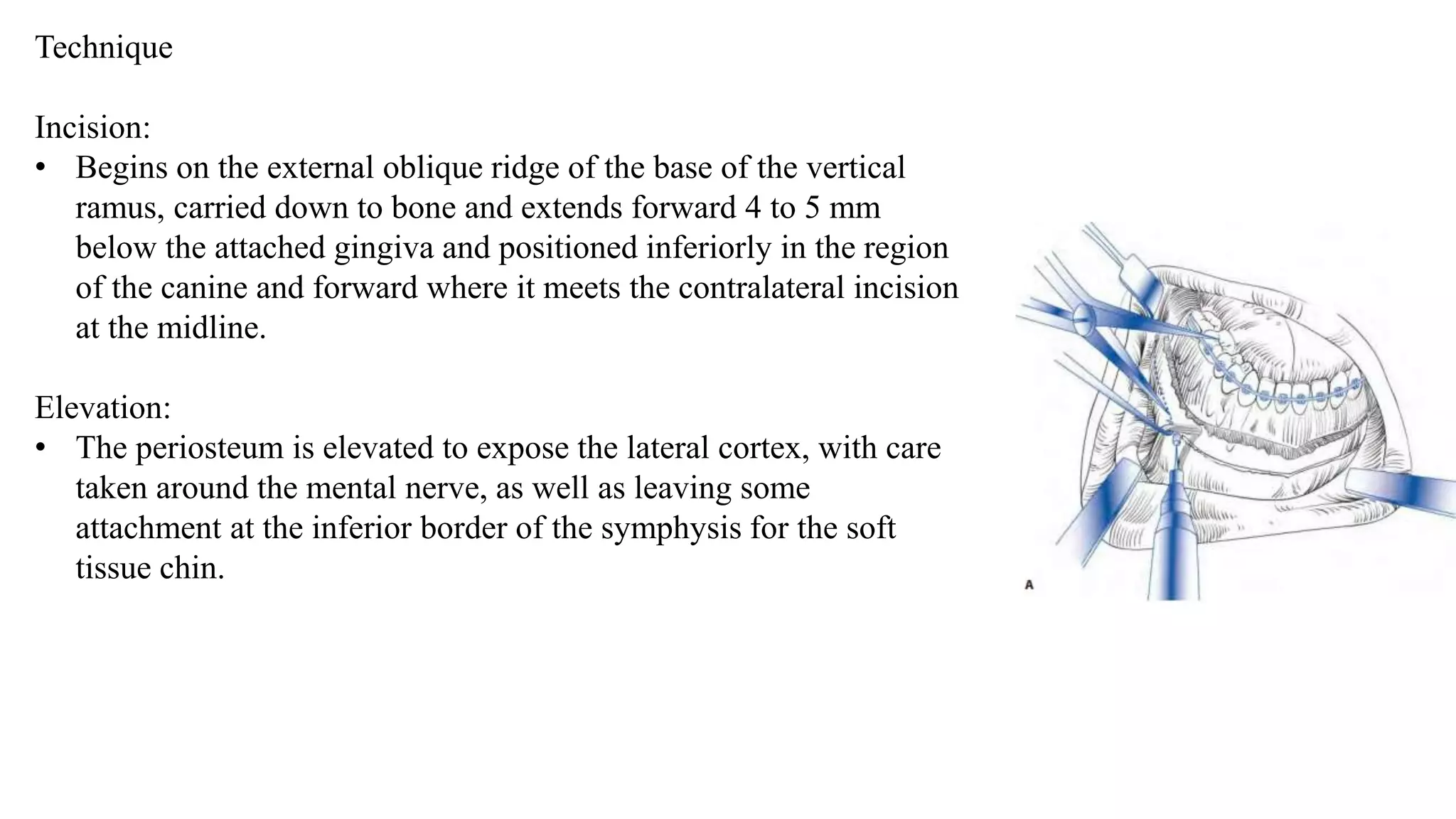 Mandibular osteotomies.pptx