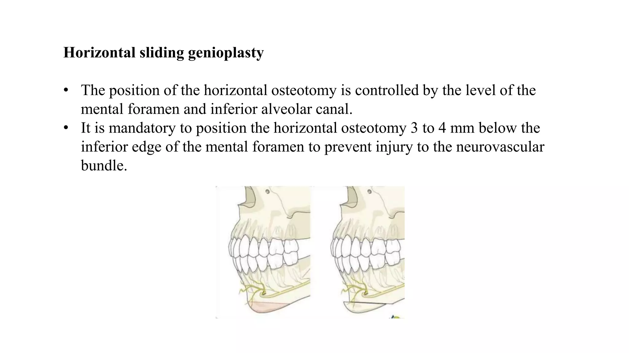 Mandibular osteotomies.pptx