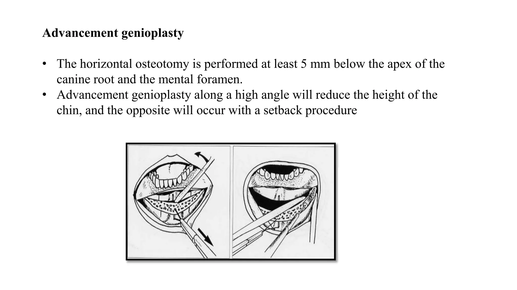 Mandibular osteotomies.pptx