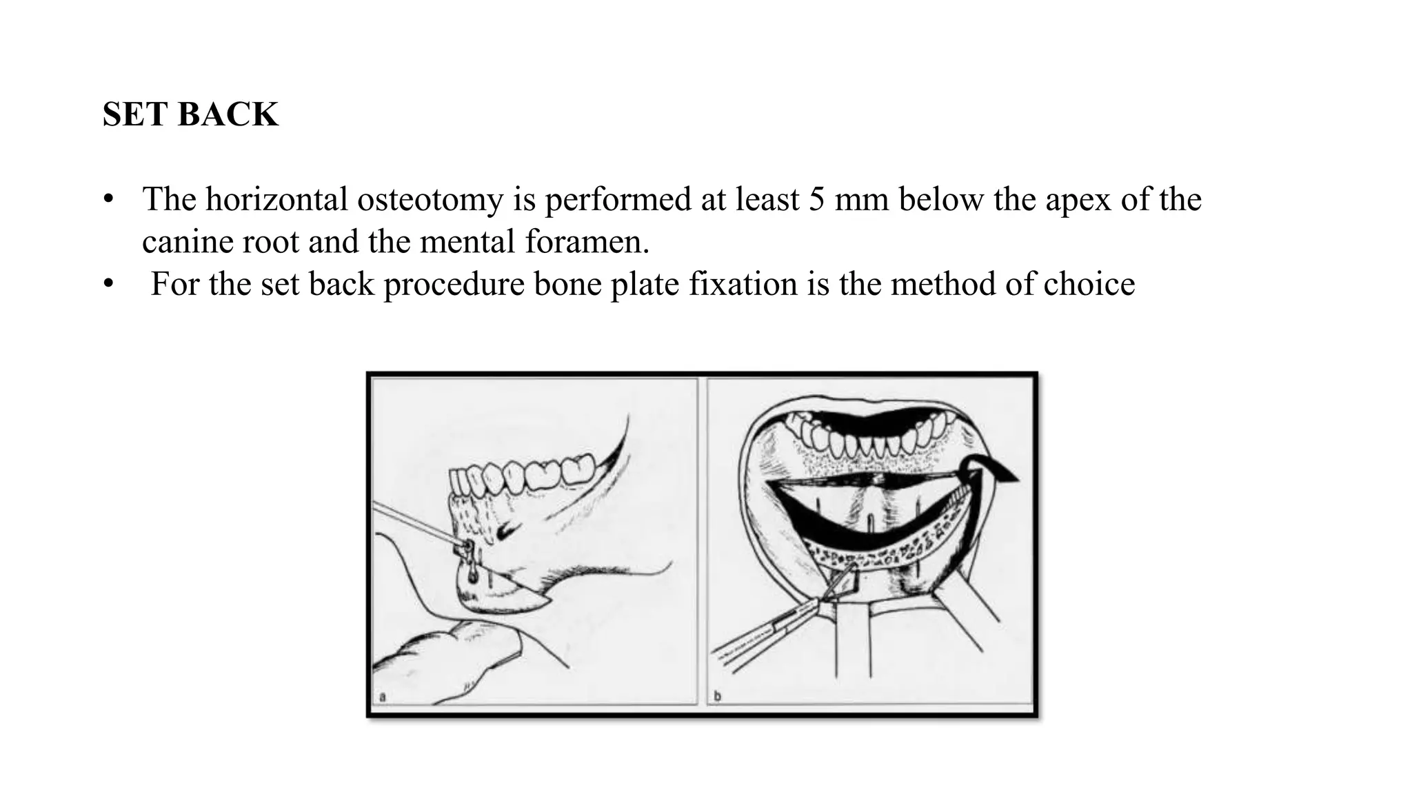 Mandibular osteotomies.pptx