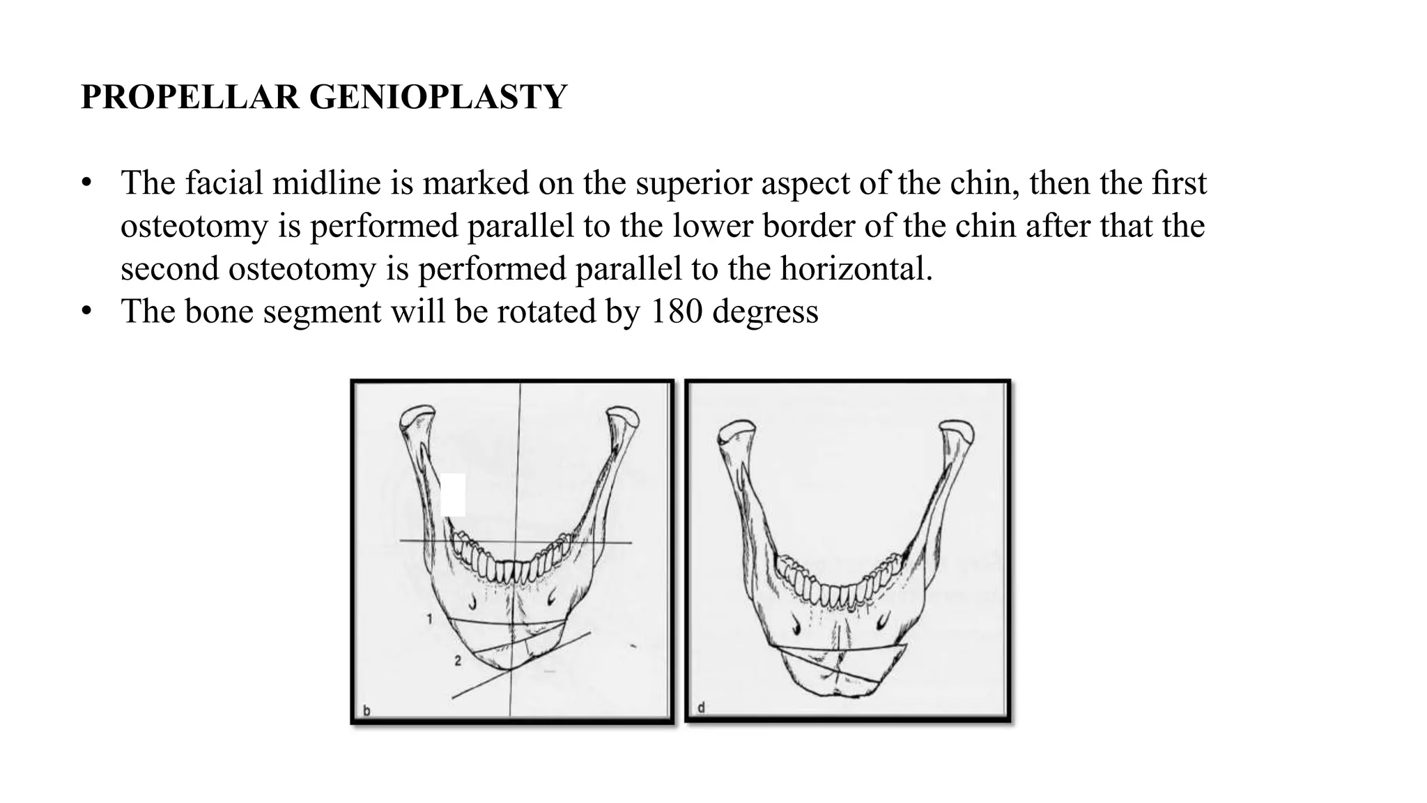Mandibular osteotomies.pptx