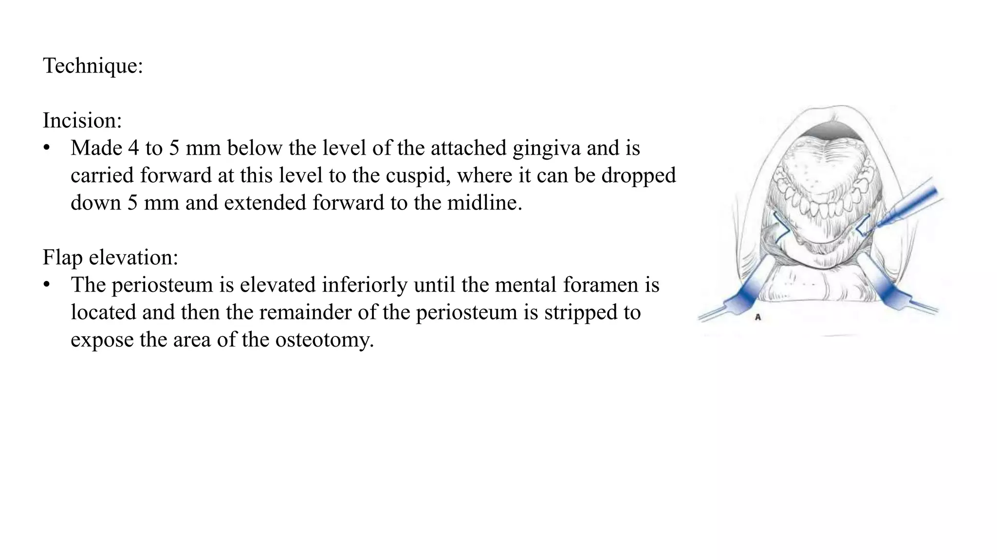 Mandibular osteotomies.pptx