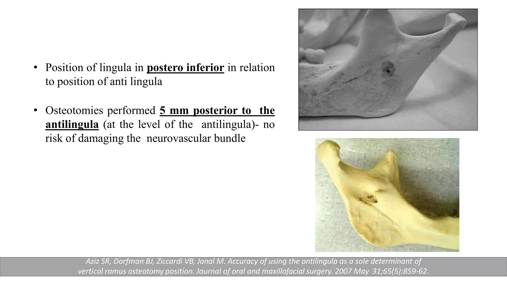 Mandibular osteotomies.pptx