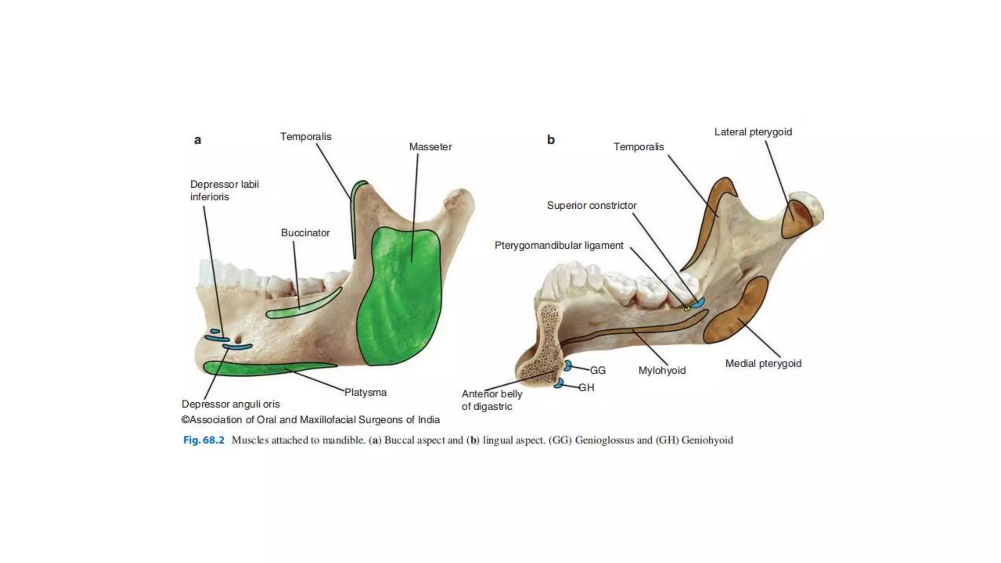 Mandibular osteotomies.pptx