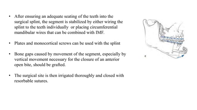 Mandibular osteotomies.pptx