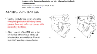 Mandibular osteotomies.pptx