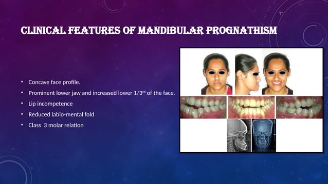 Surgical procedures for Mandibular Osteotomy | PPTX