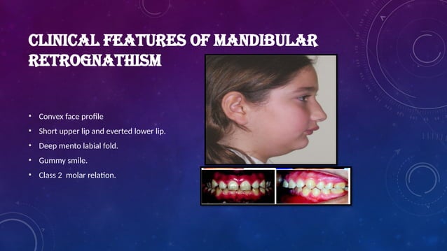 Surgical procedures for Mandibular Osteotomy | PPTX