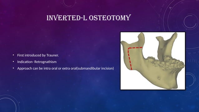 Surgical procedures for Mandibular Osteotomy | PPTX