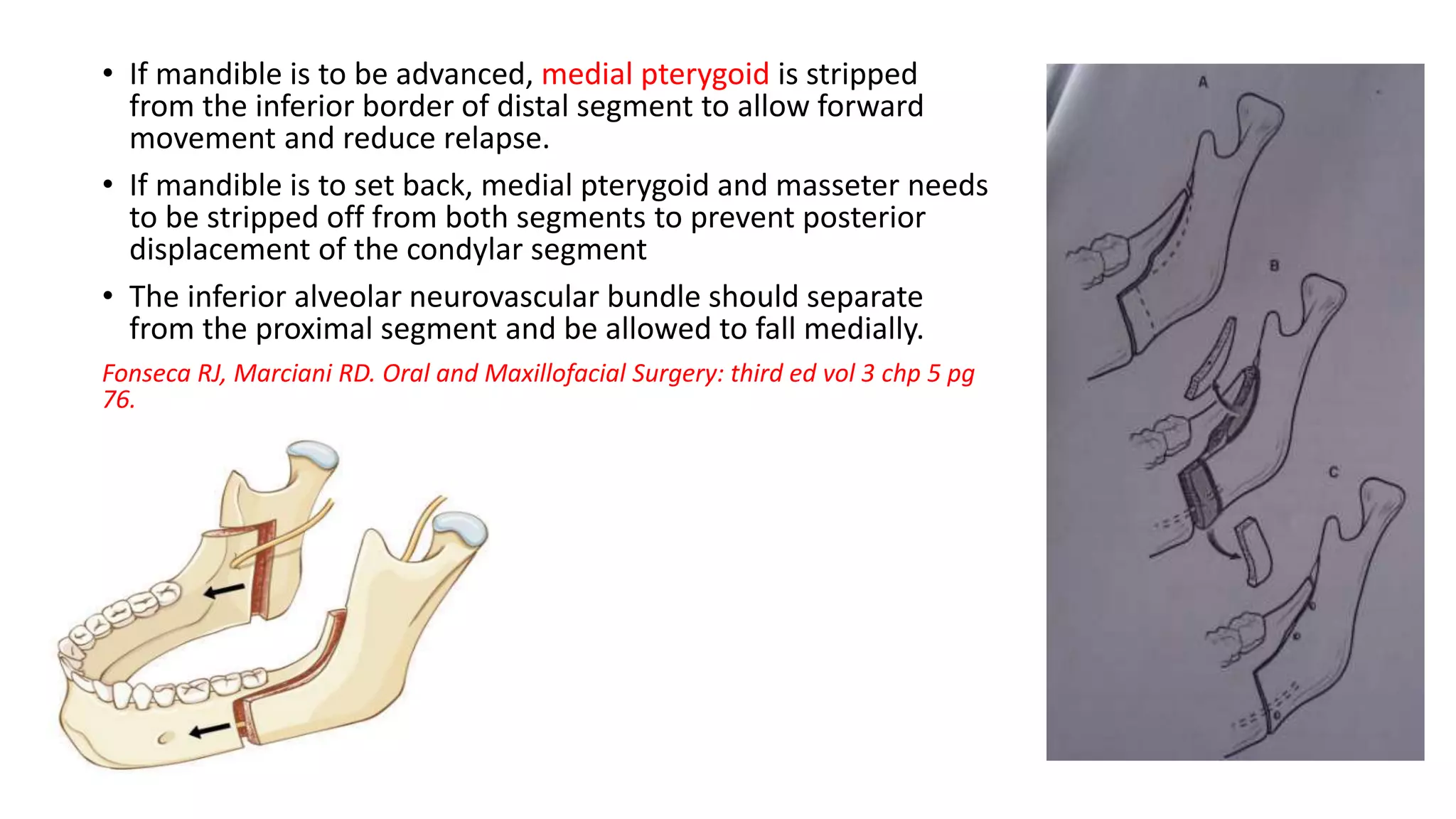 Mandibular osteotomy and genioplasty | PPTX