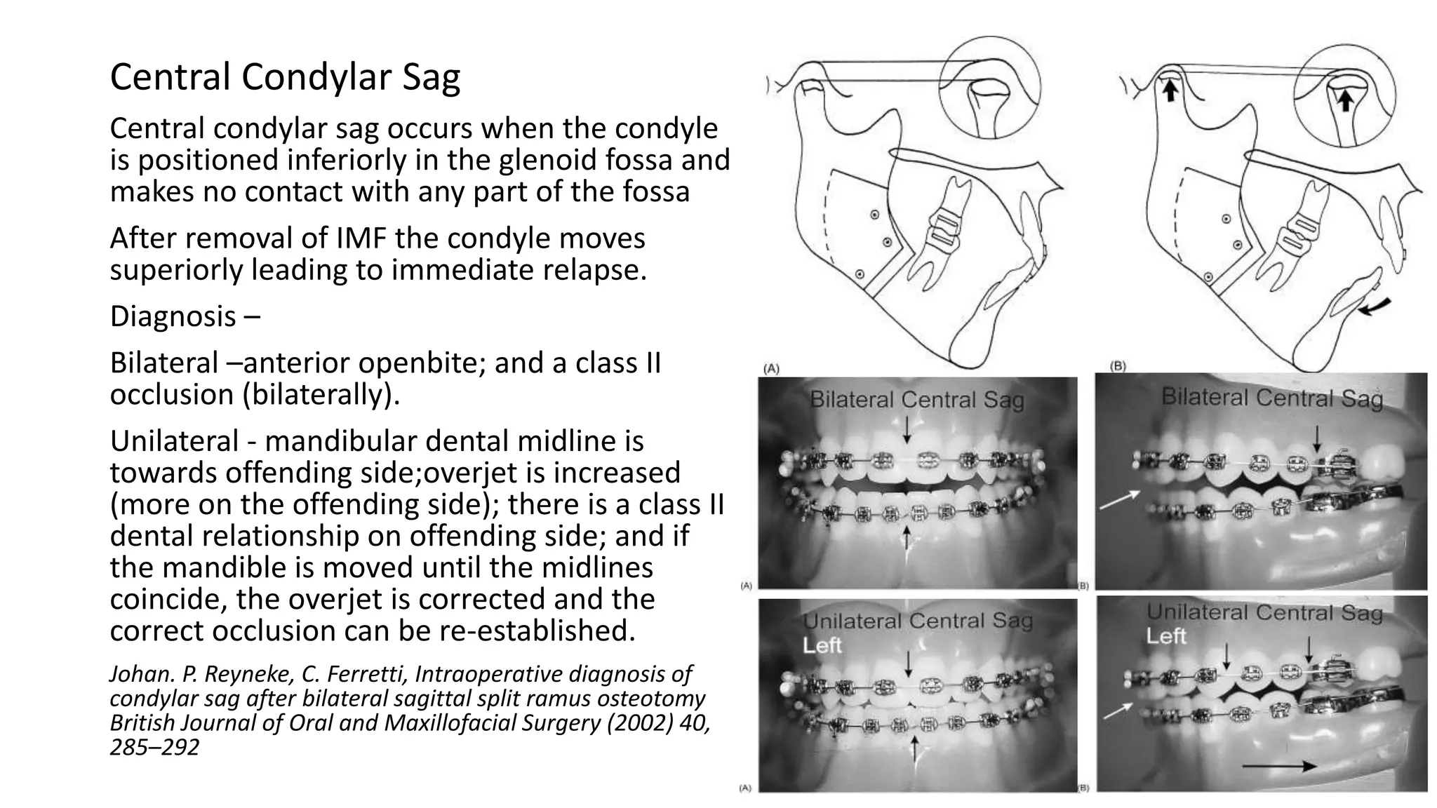 Mandibular osteotomy and genioplasty | PPTX