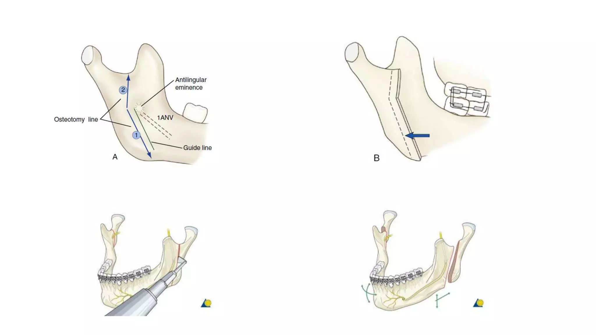 Mandibular osteotomy and genioplasty | PPTX