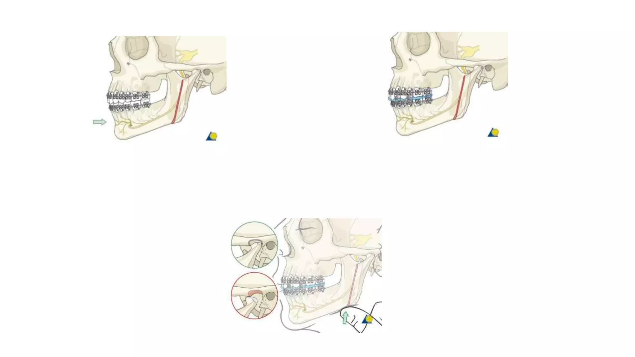 Mandibular osteotomy and genioplasty | PPTX