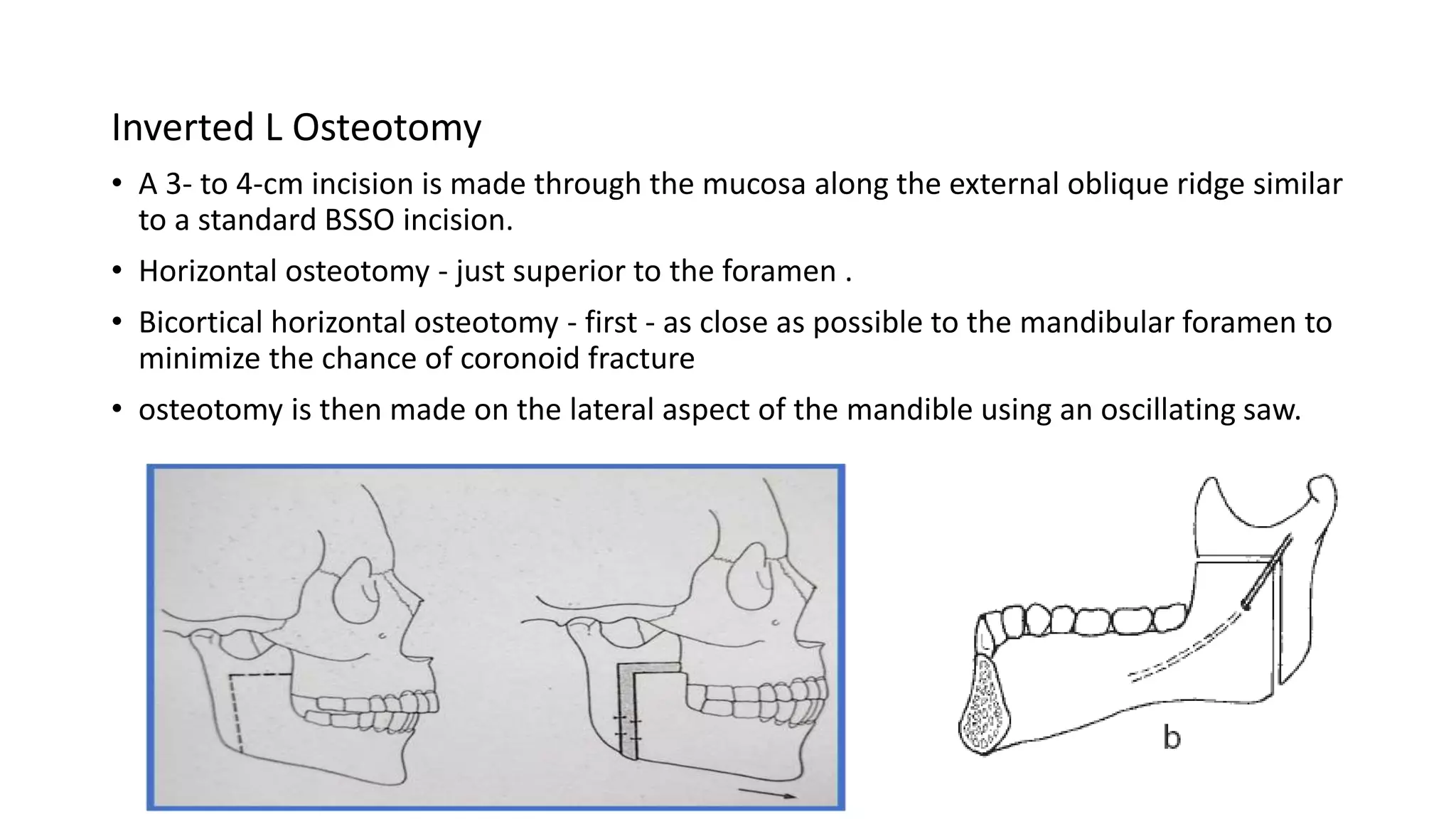 Mandibular osteotomy and genioplasty | PPTX