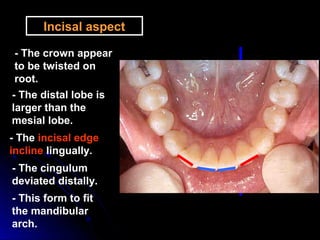 Mandibular permanent incisors | PPT