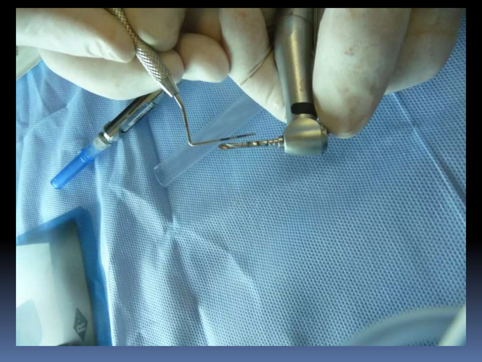 Mandibular Pre Molar Region Implant Placement Near Mental Nerve | PPTX