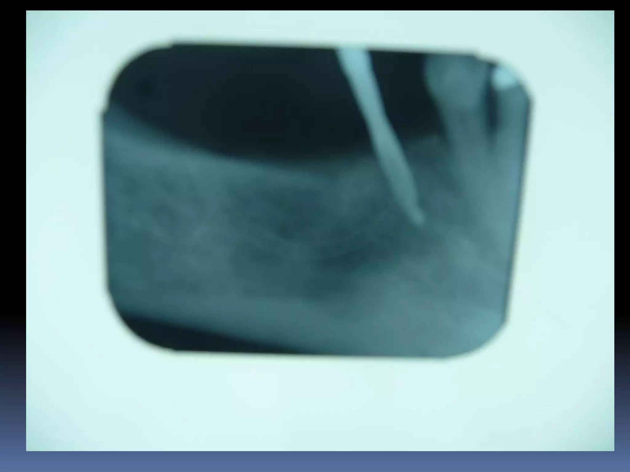 Mandibular Pre Molar Region Implant Placement Near Mental Nerve | PPTX