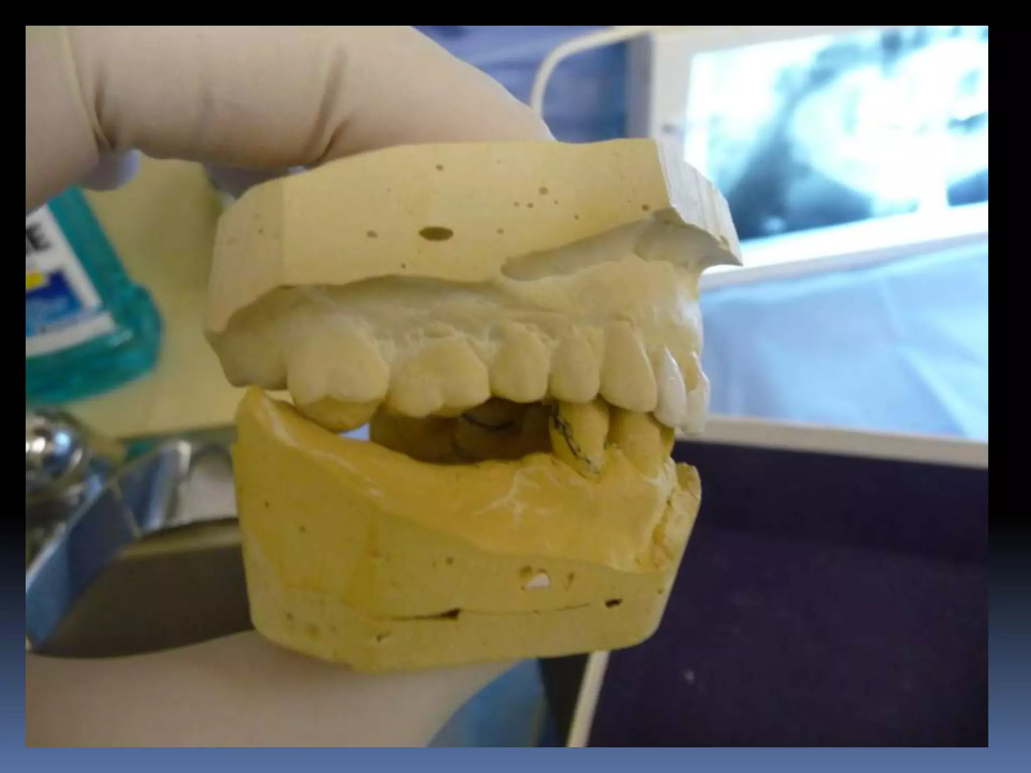 Mandibular Pre Molar Region Implant Placement Near Mental Nerve | PPTX
