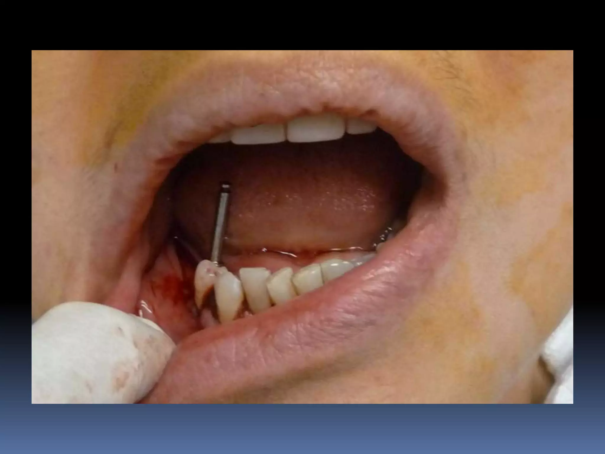 Mandibular Pre Molar Region Implant Placement Near Mental Nerve | PPTX