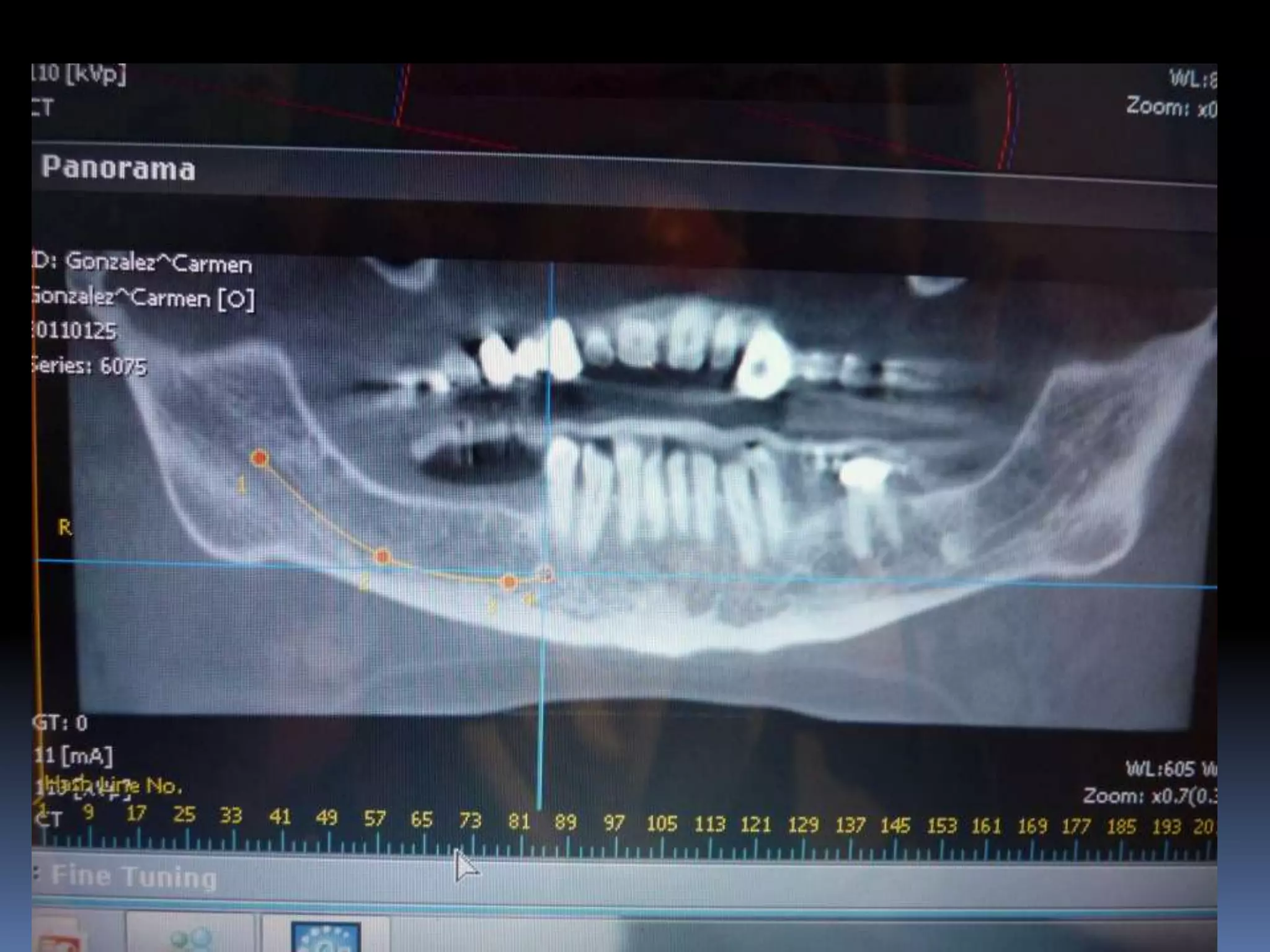 Mandibular Pre Molar Region Implant Placement Near Mental Nerve Ppt