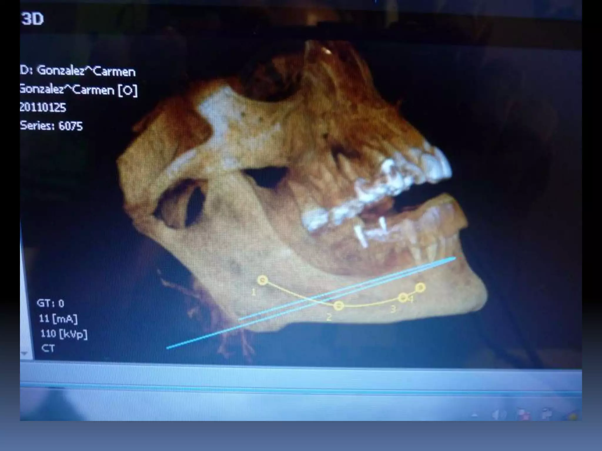 Mandibular Pre Molar Region Implant Placement Near Mental Nerve | PPTX