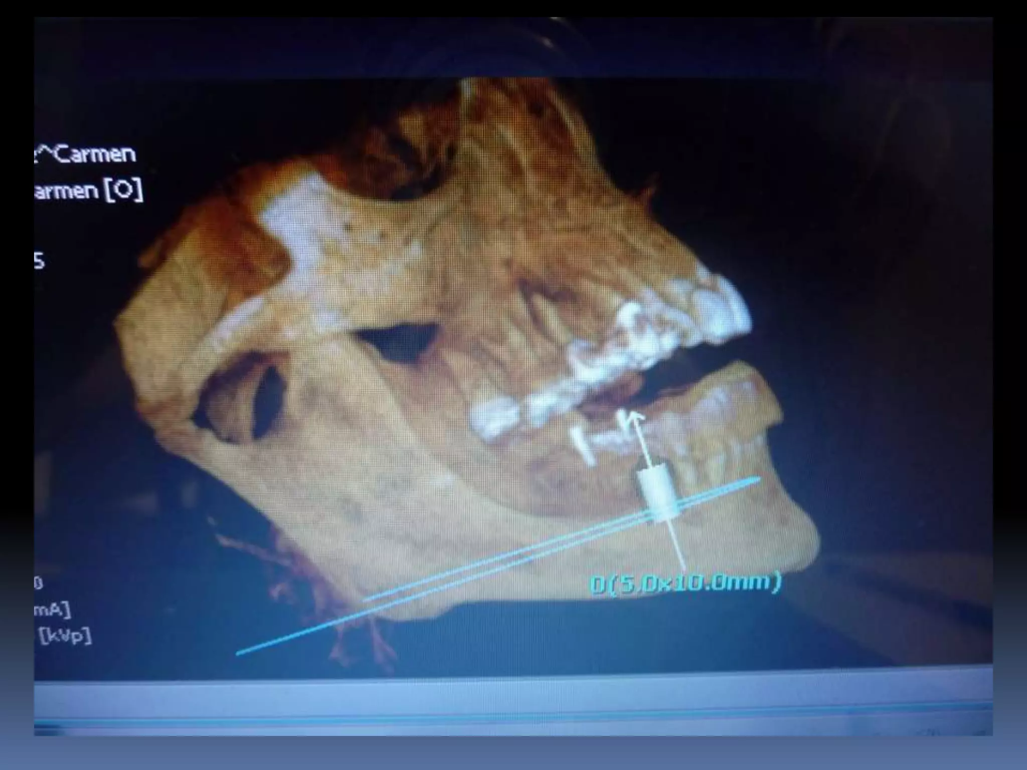 Mandibular Pre Molar Region Implant Placement Near Mental Nerve | PPTX