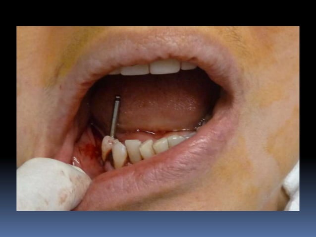 Mandibular Pre Molar Region Implant Placement Near Mental Nerve Ppt