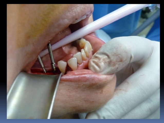 Mandibular Pre Molar Region Implant Placement Near Mental Nerve | PPTX