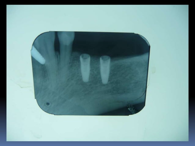 Mandibular Pre Molar Region Implant Placement Near Mental Nerve Ppt