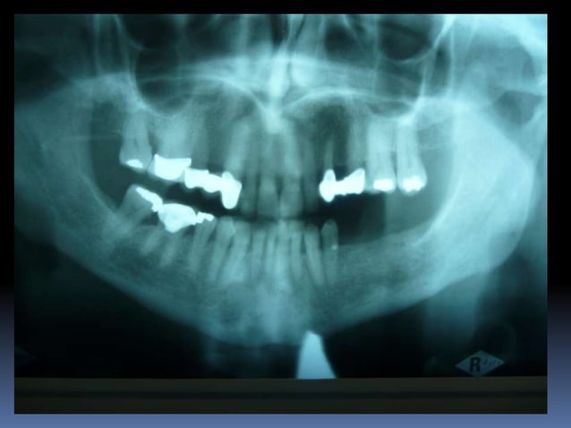 Mandibular Pre Molar Region Implant Placement Near Mental Nerve