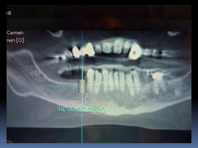 Mandibular Pre Molar Region Implant Placement Near Mental Nerve