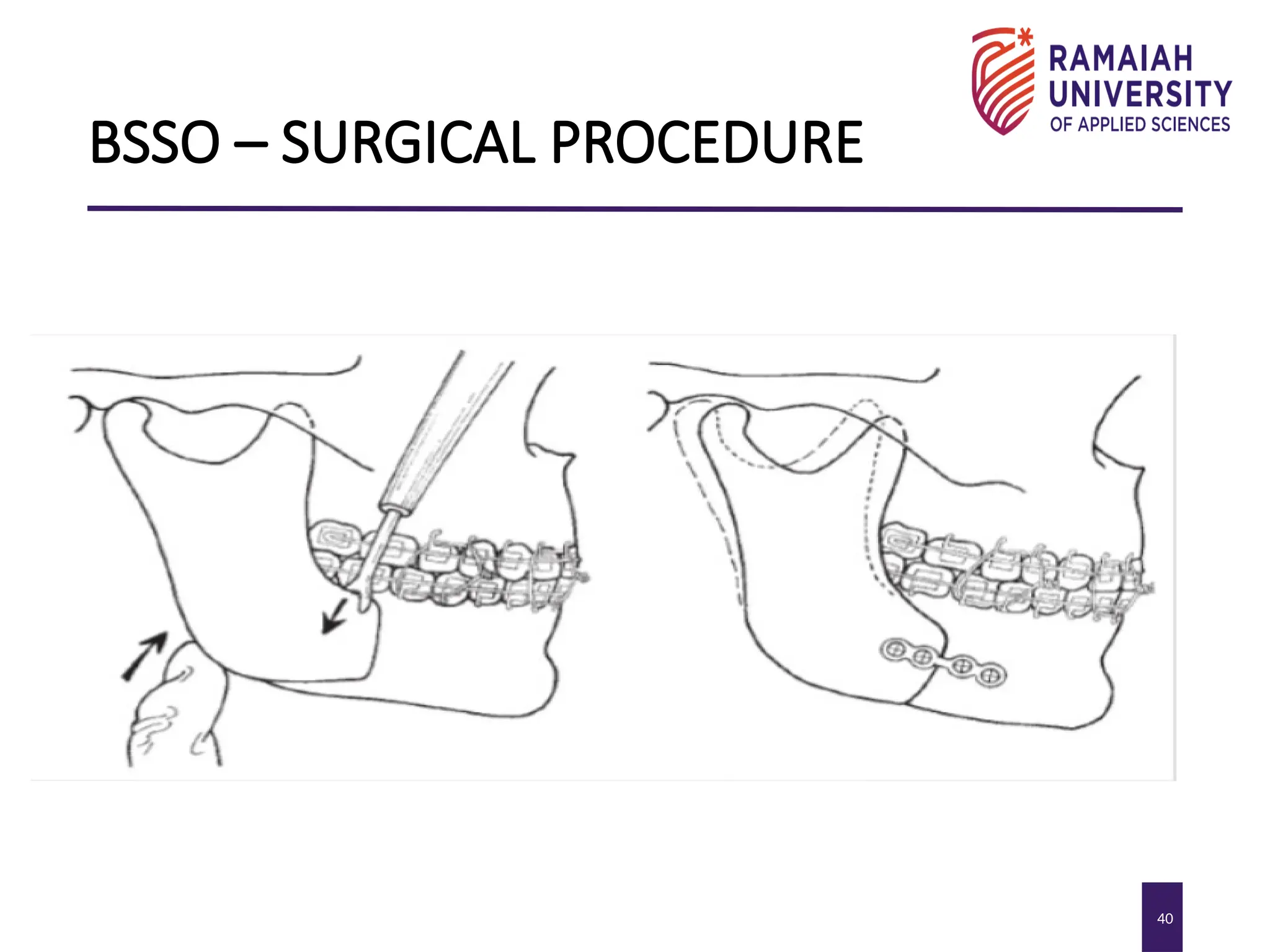 MANDIBULAR PROCEDURES INCLUDING GENIOPLASTY (2).pptx