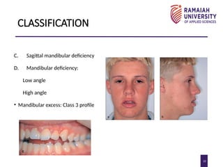 MANDIBULAR PROCEDURES INCLUDING GENIOPLASTY (2).pptx